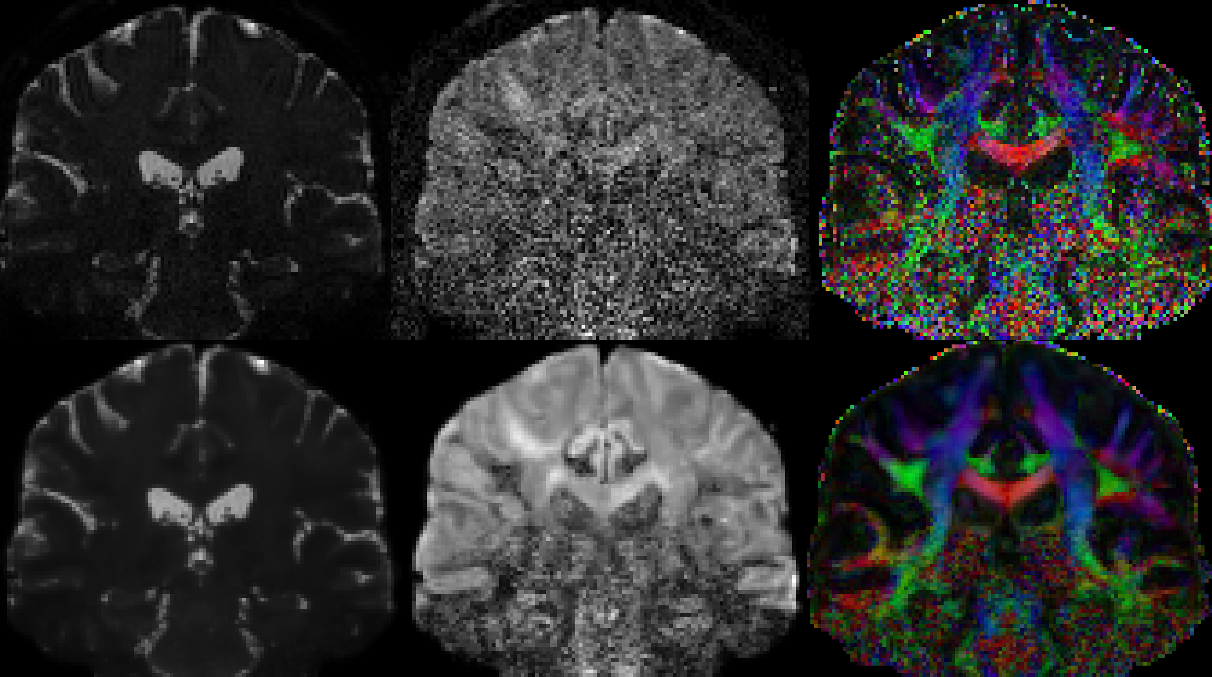 Non Local Spatial and Angular Matching (NLSAM) denoising | Samuel St-Jean